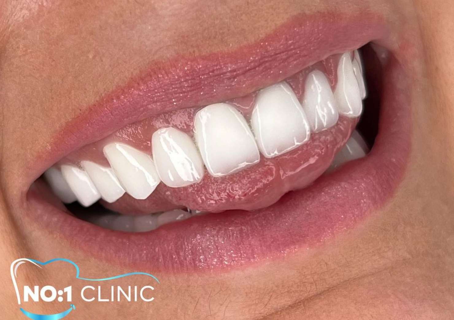 Porcelain vs Composite Veneers • No1 Clinic